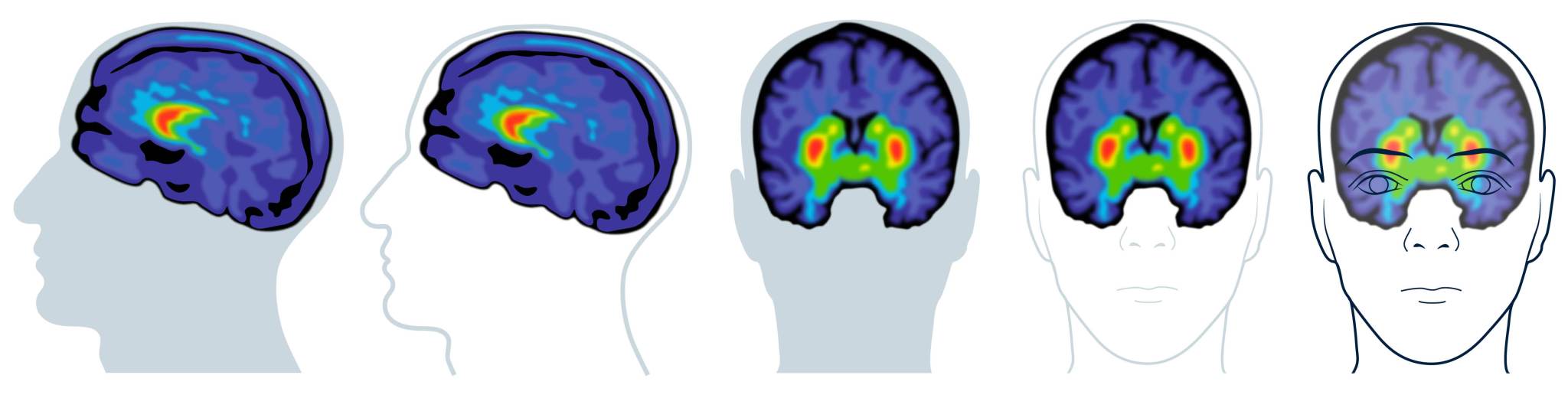Revising the FDOPA PET imaging leaflet – Neuroscience & graphic design